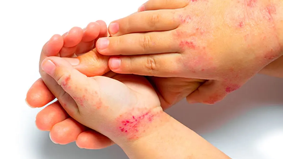 Dermatitis atópica: qué es y cómo impacta en las personas