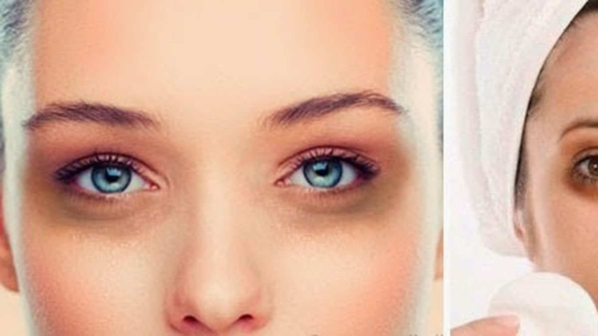 5 soluciones naturales e instantáneas para las ojeras
