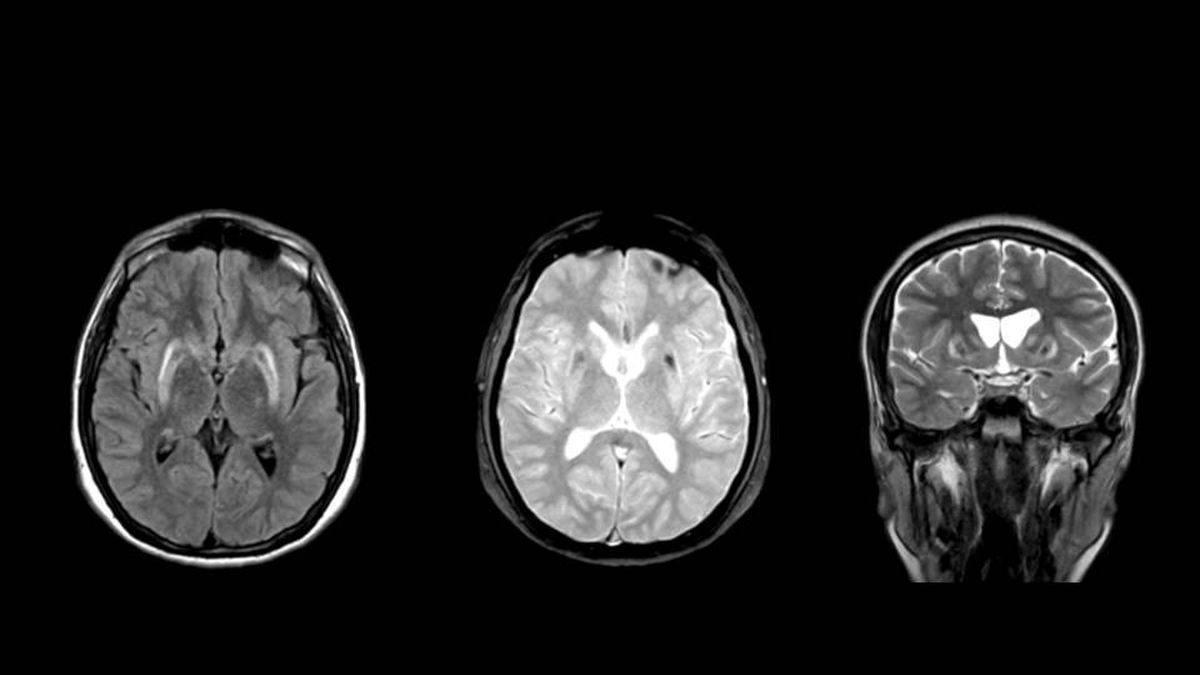 Síndrome de Hakim-Adams o hidrocefalia de presión normal, otra afección ...